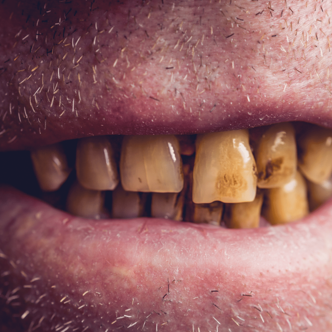 What Alcohol Will Do to Your Teeth - Charlotte Progressive Dentistry ...