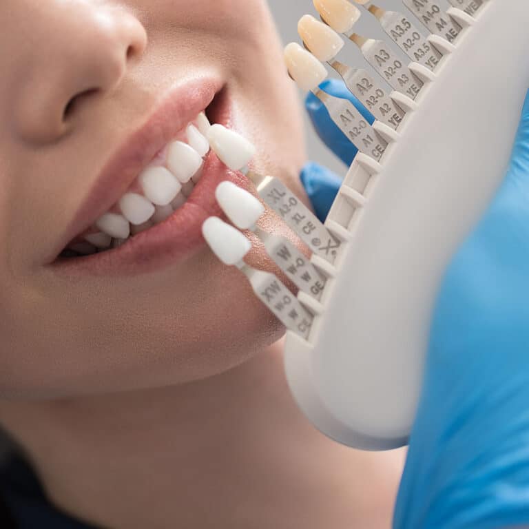 An Overview of Teeth Staining - Charlotte Progressive Dentistry Dentist ...